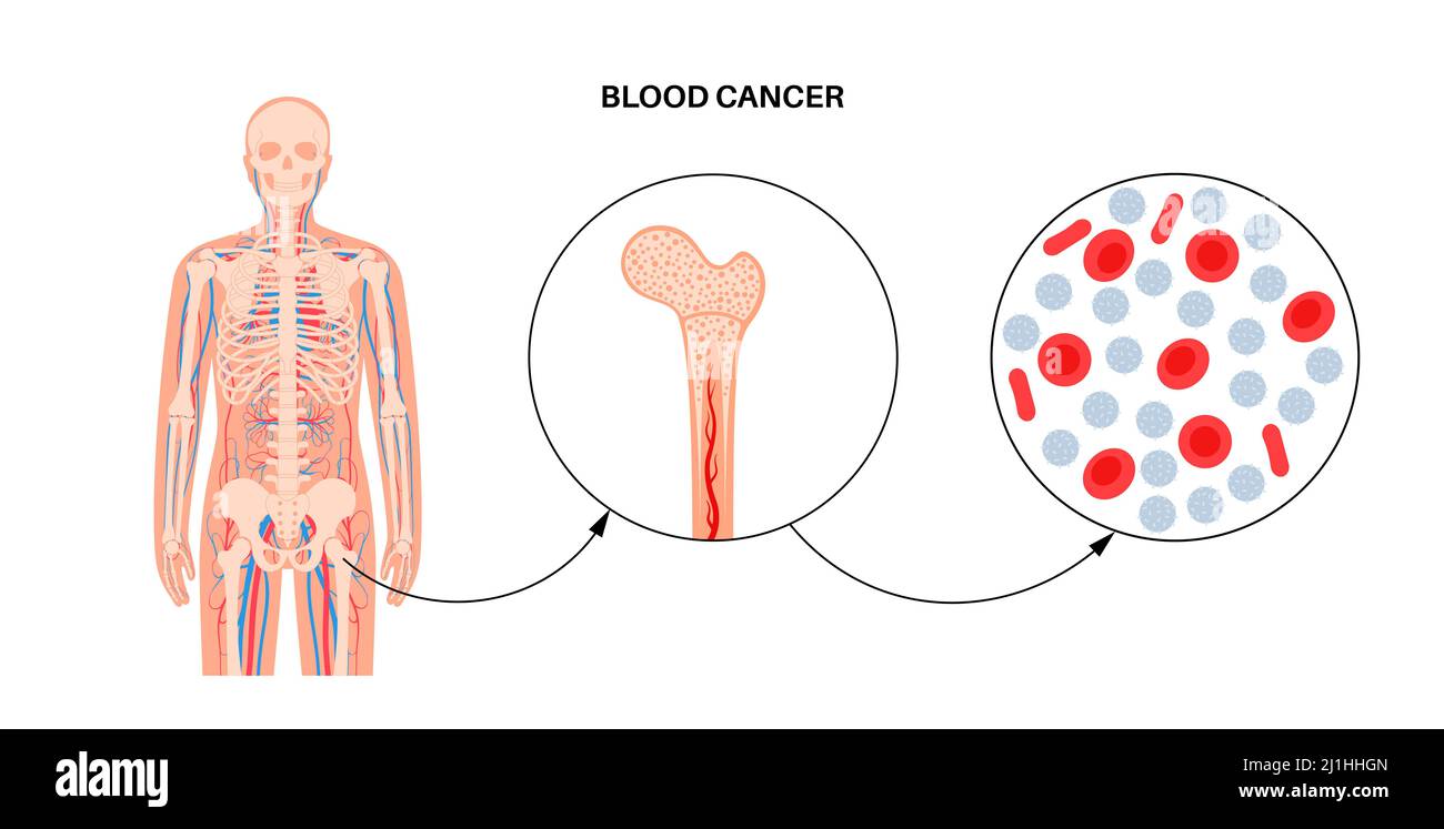 Marrow bone deficiency hi-res stock photography and images - Alamy