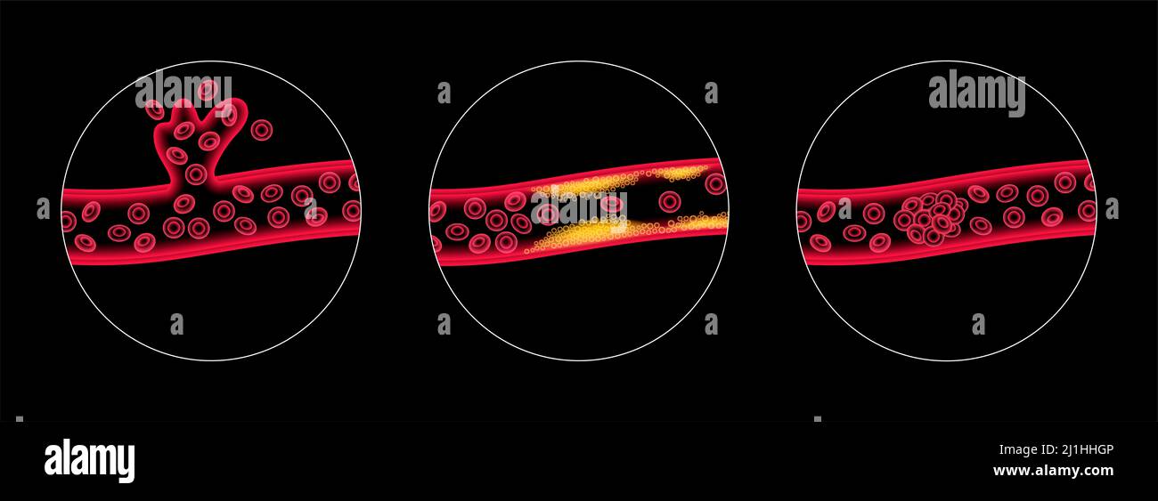 Ischaemic and haemorrhagic strokes, illustration Stock Photo - Alamy