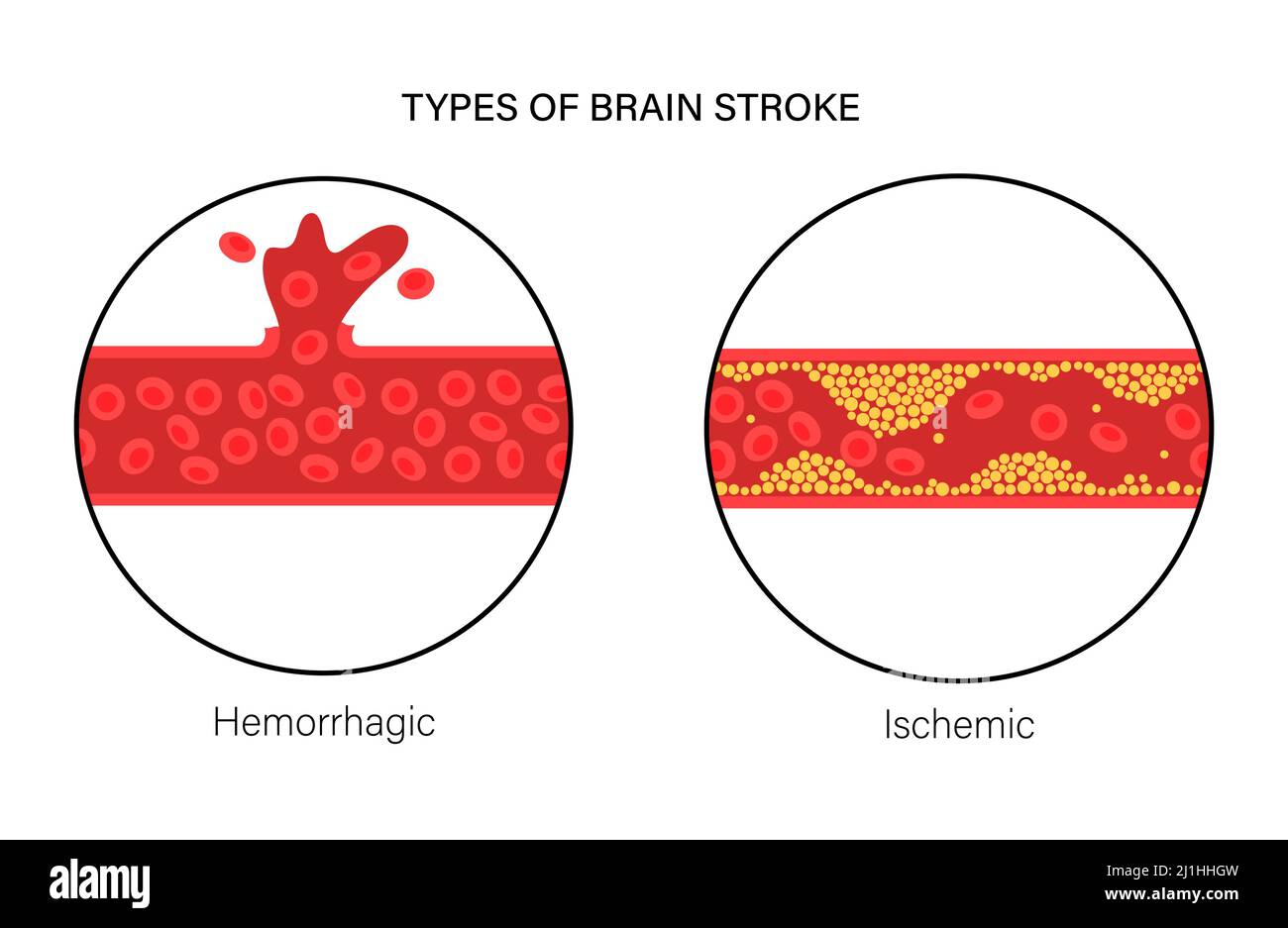 Ischaemic and haemorrhagic strokes, illustration Stock Photo - Alamy