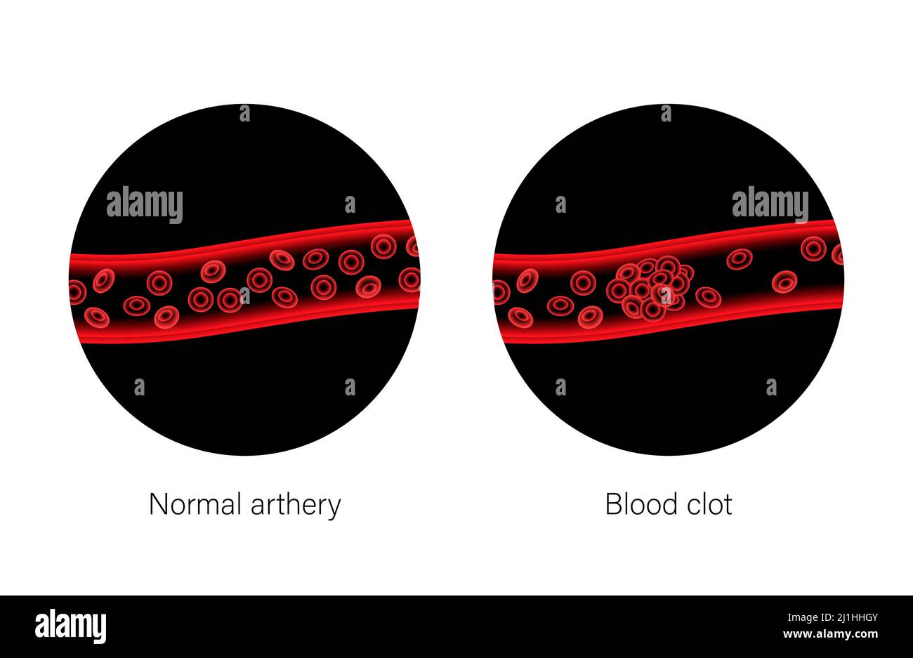 Ischaemic and haemorrhagic strokes, illustration Stock Photo - Alamy