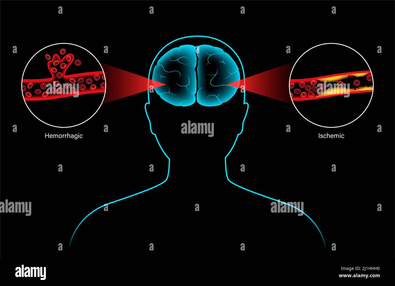 Ischaemic and haemorrhagic strokes, illustration Stock Photo - Alamy
