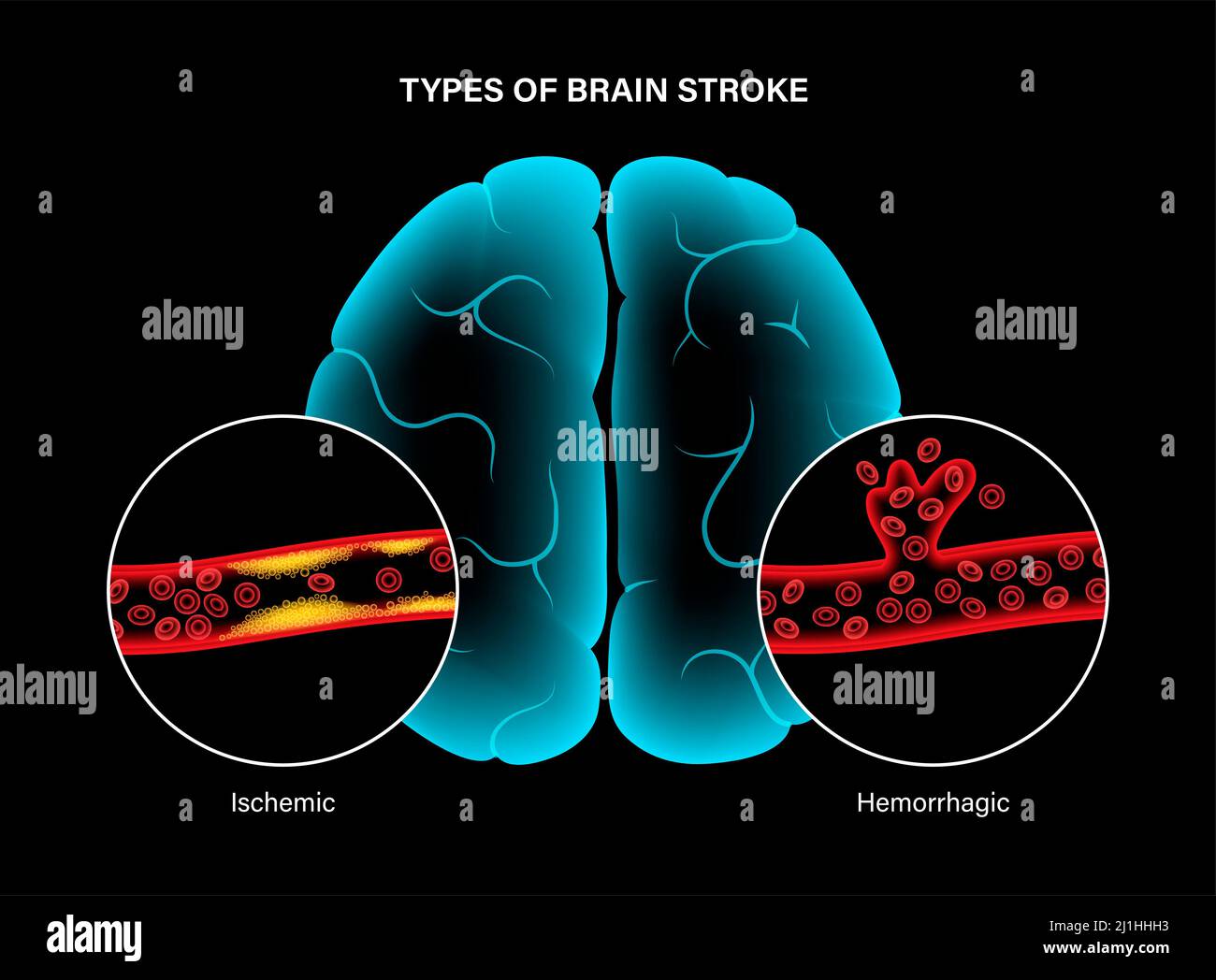 Ischaemic and haemorrhagic strokes, illustration Stock Photo - Alamy