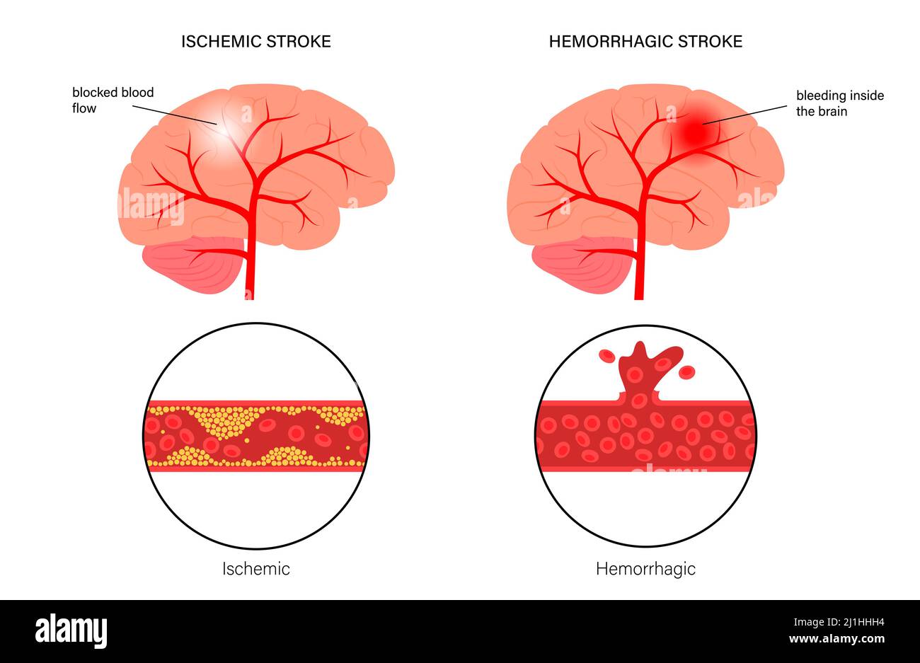 Ischaemic and haemorrhagic strokes, illustration Stock Photo - Alamy