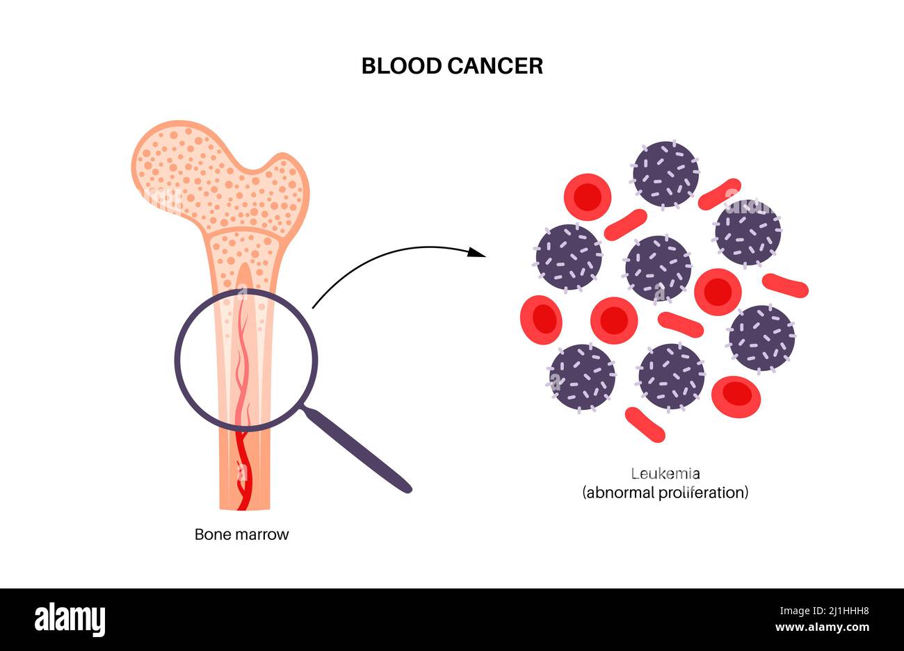 Chronic myeloid leukaemia hi-res stock photography and images - Alamy