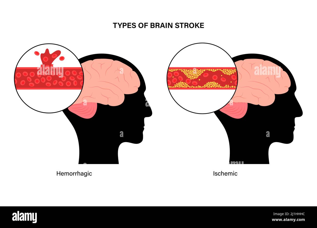 Ischaemic and haemorrhagic strokes, illustration Stock Photo - Alamy