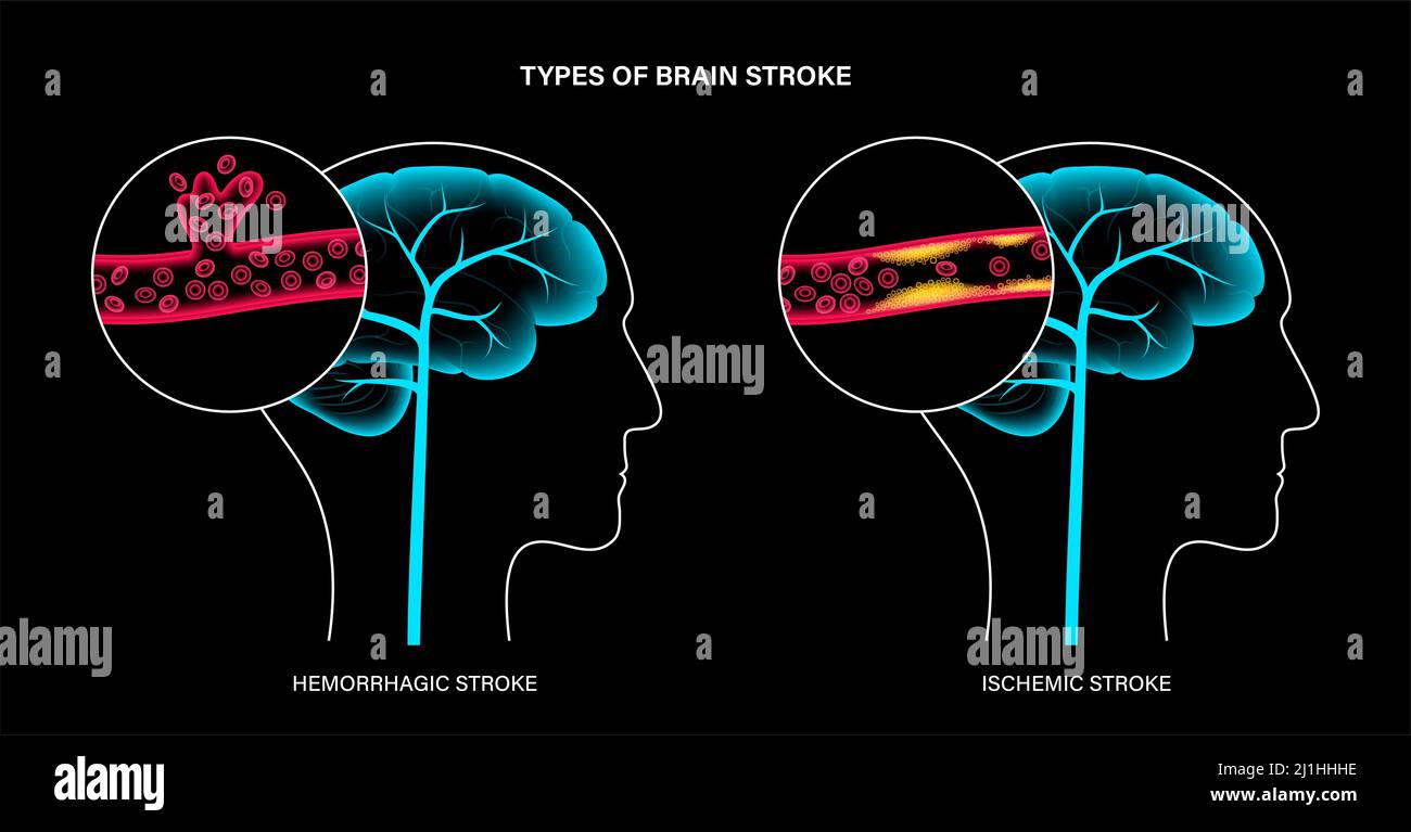 Ischaemic and haemorrhagic strokes, illustration Stock Photo - Alamy