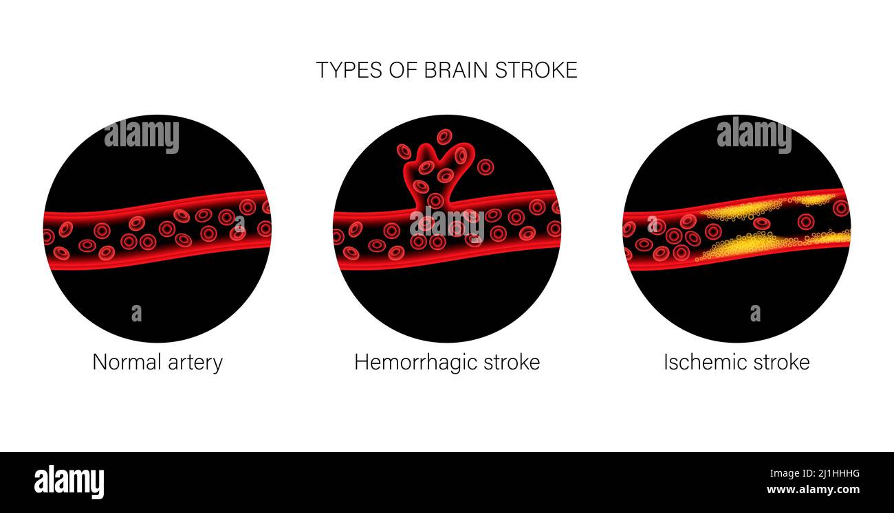 Ischaemic and haemorrhagic strokes, illustration Stock Photo - Alamy