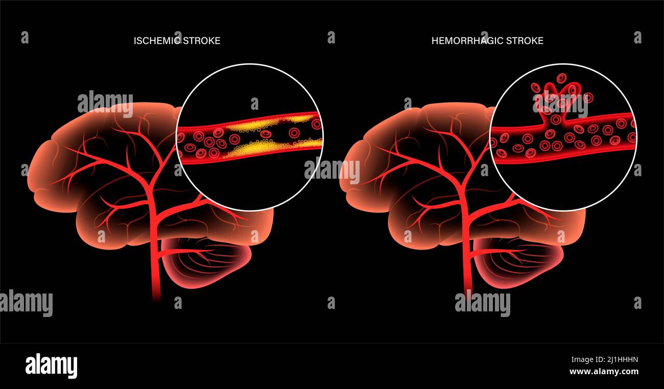 Ischaemic and haemorrhagic strokes, illustration Stock Photo - Alamy