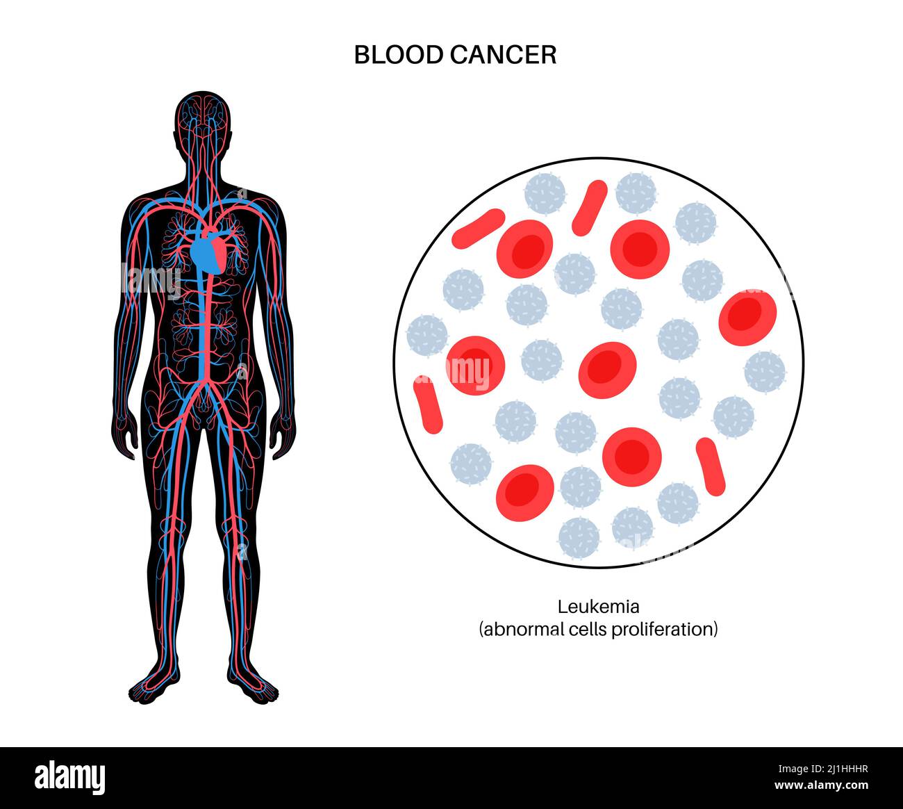 Chronic myeloid leukaemia hi-res stock photography and images - Alamy