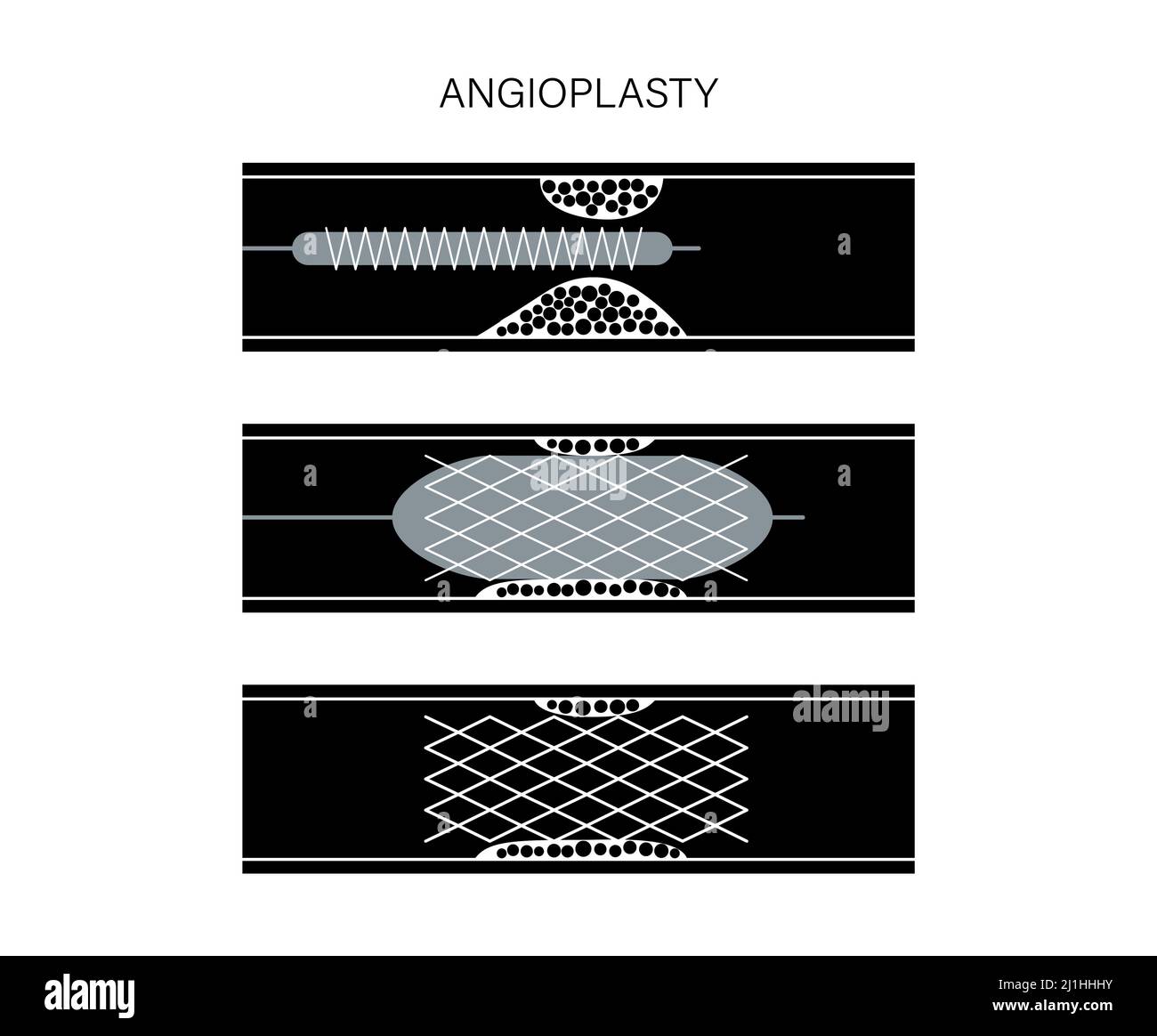 Angioplasty operation Cut Out Stock Images & Pictures - Alamy