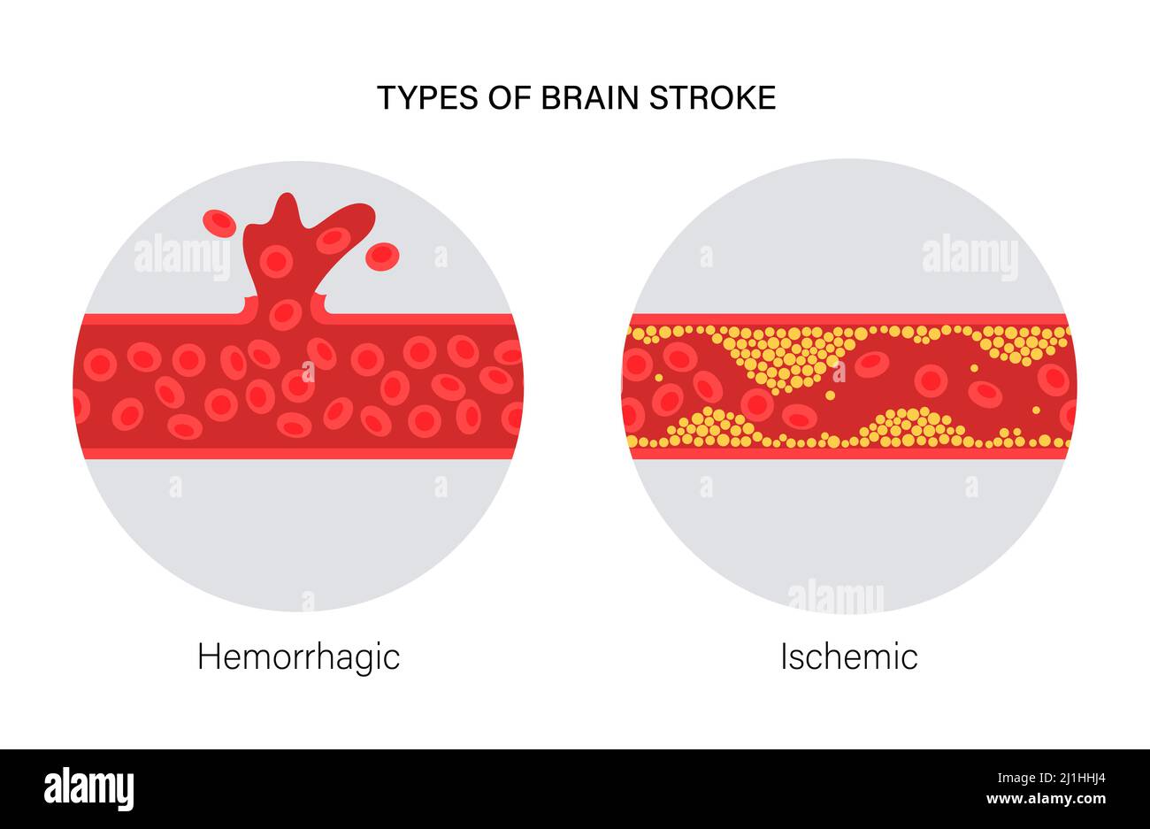 Ischaemic and haemorrhagic strokes, illustration Stock Photo - Alamy