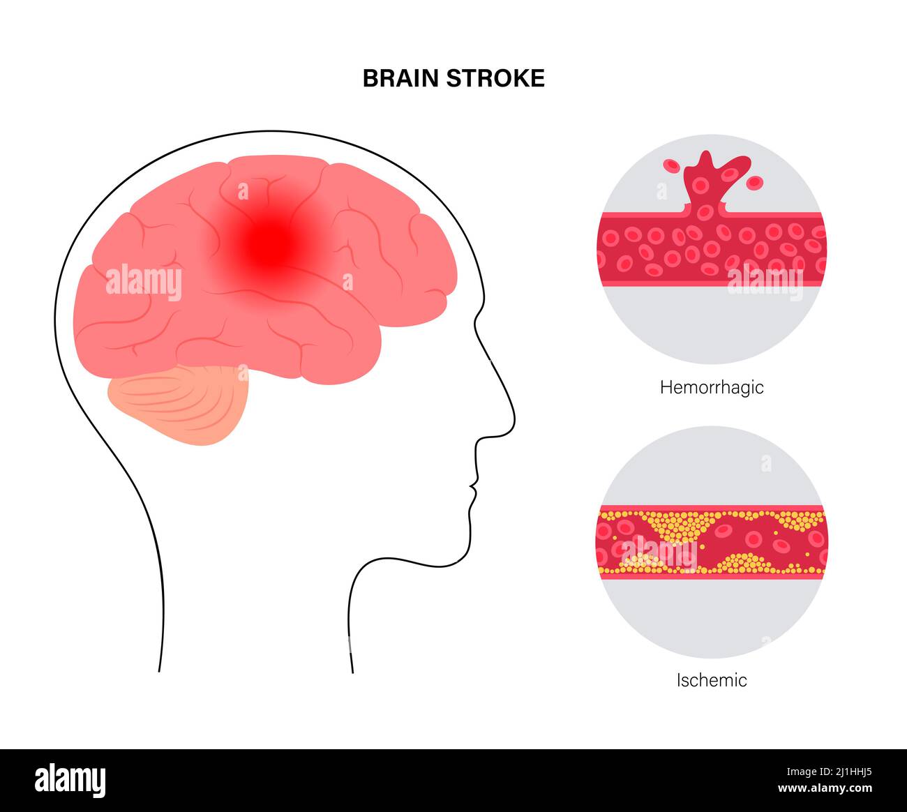 Ischaemic and haemorrhagic strokes, illustration Stock Photo - Alamy