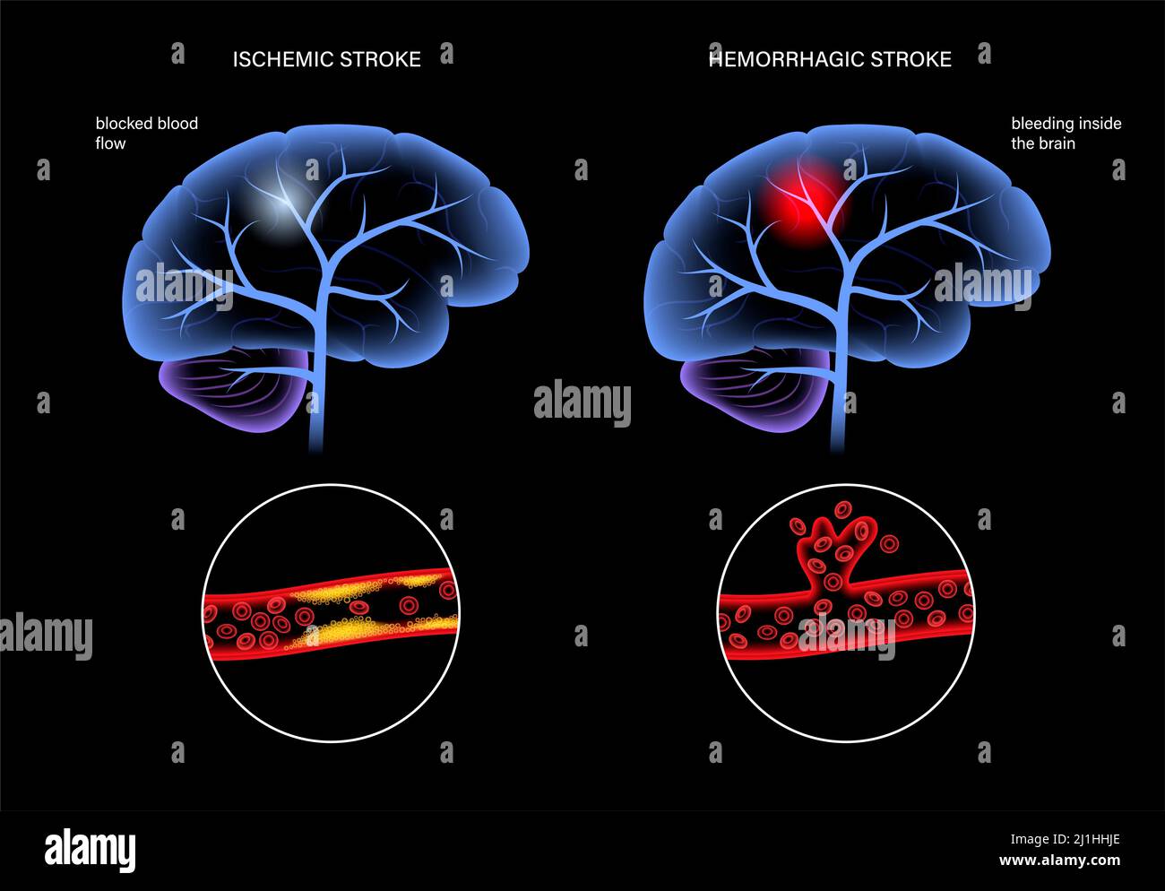 Ischaemic and haemorrhagic strokes, illustration Stock Photo - Alamy