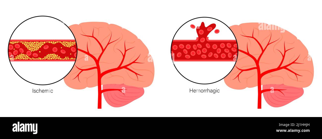 Ischaemic and haemorrhagic strokes, illustration Stock Photo - Alamy