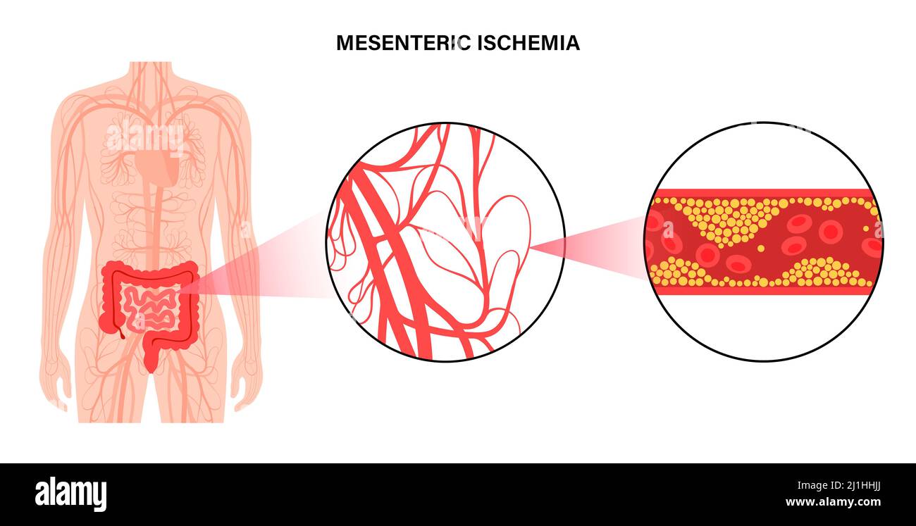 Mesenteric artery hi-res stock photography and images - Alamy