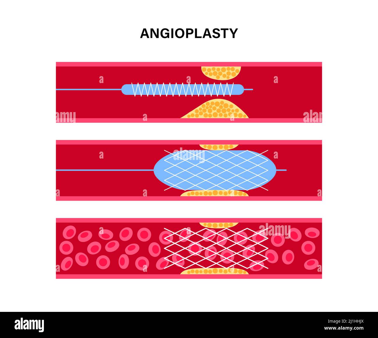 Angioplasty operation Cut Out Stock Images & Pictures - Alamy