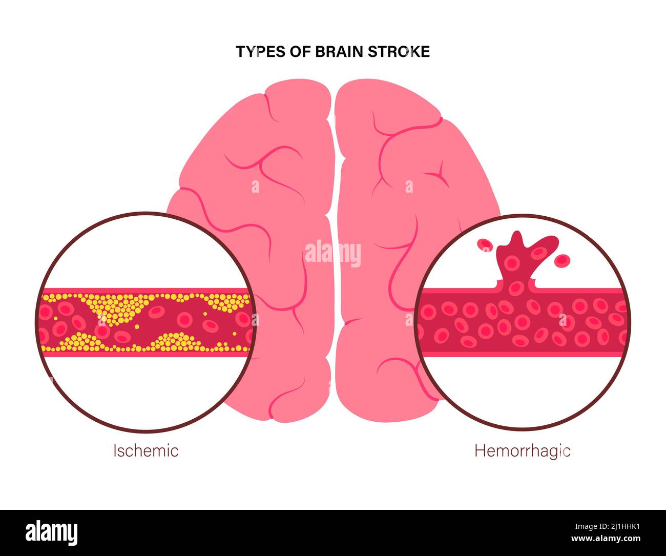 Ischaemic and haemorrhagic strokes, illustration Stock Photo - Alamy