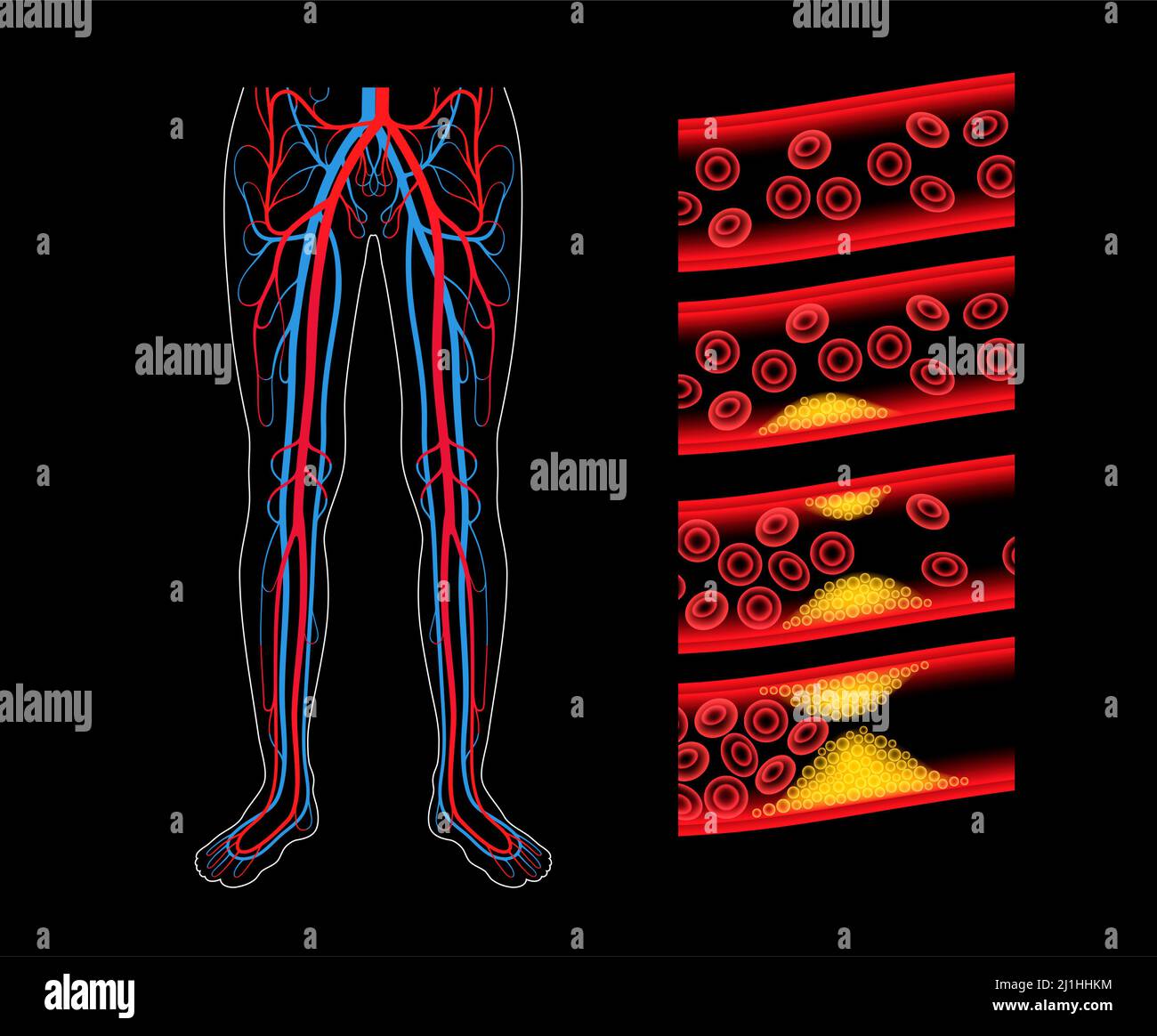 Peripheral artery disease, illustration Stock Photo - Alamy