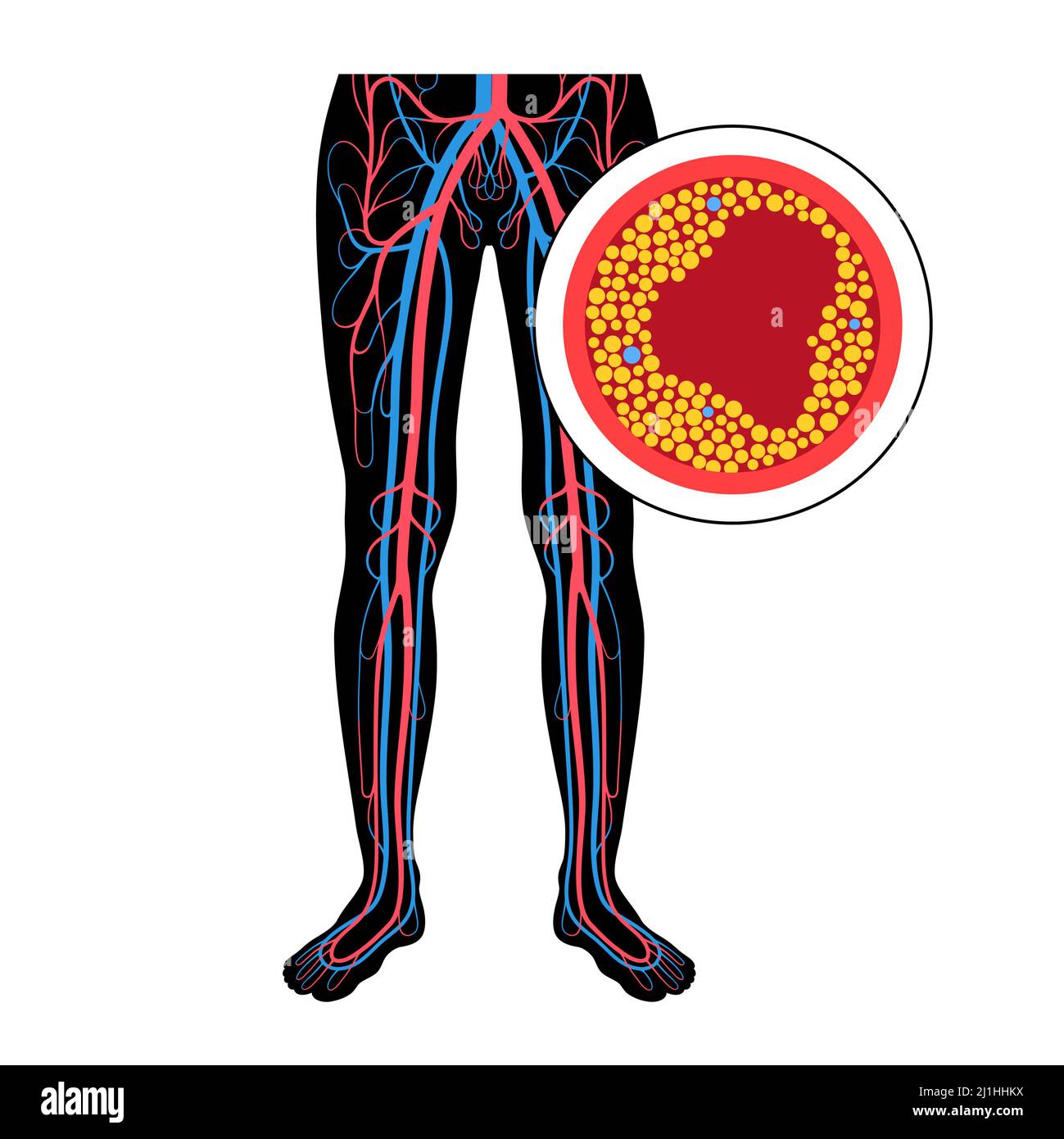 Peripheral vascular disease hi-res stock photography and images - Alamy