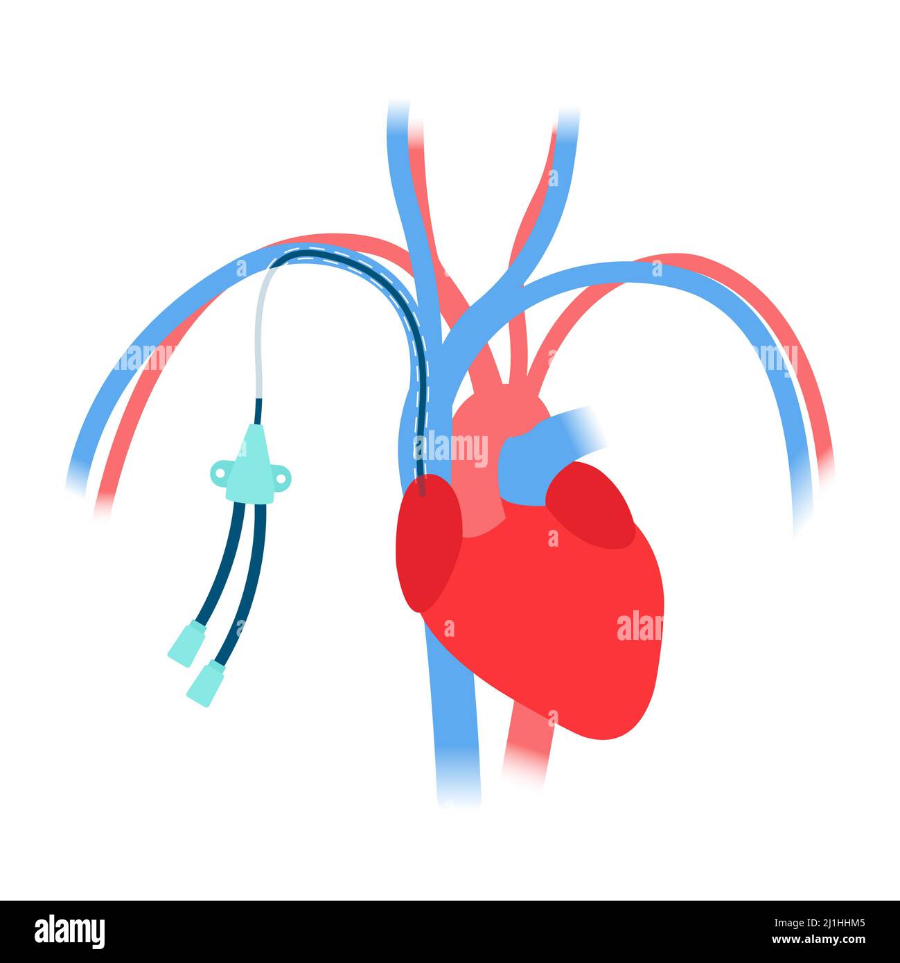Central venous catheter, illustration Stock Photo - Alamy
