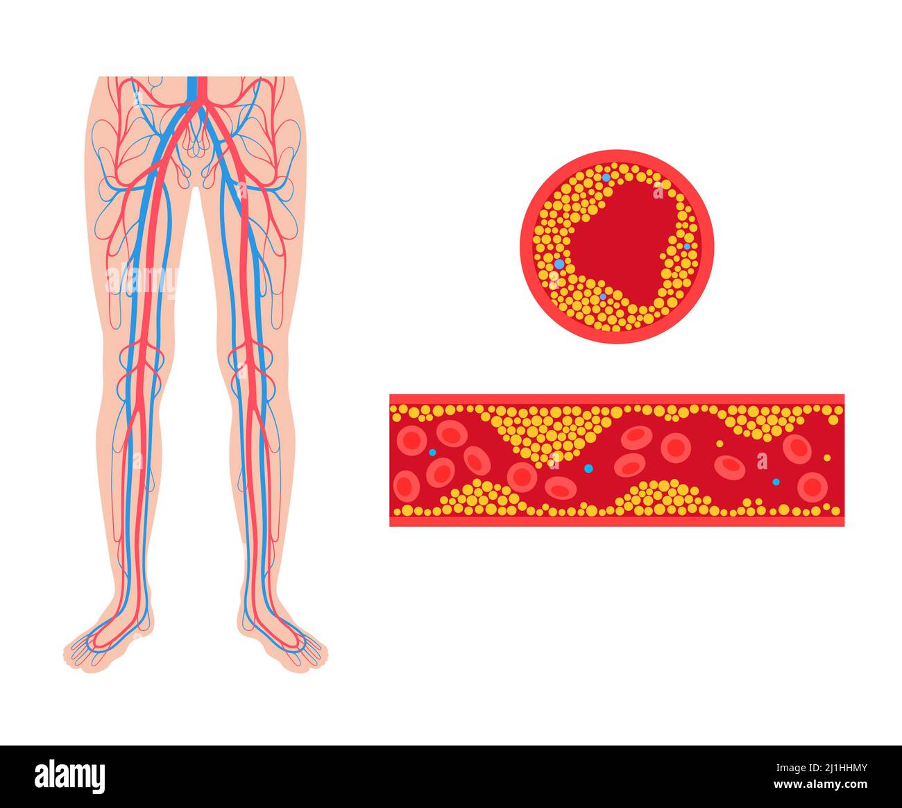 Peripheral artery disease, illustration Stock Photo - Alamy