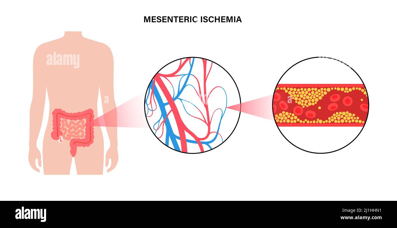 Mesenteric artery hi-res stock photography and images - Alamy