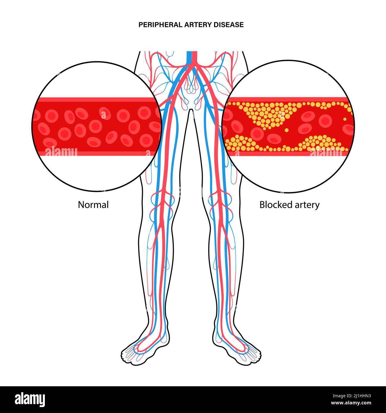 Peripheral artery disease, illustration Stock Photo - Alamy