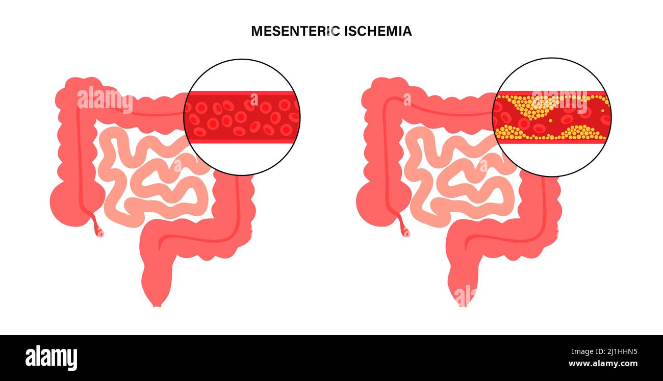 Mesenteric hi-res stock photography and images - Alamy