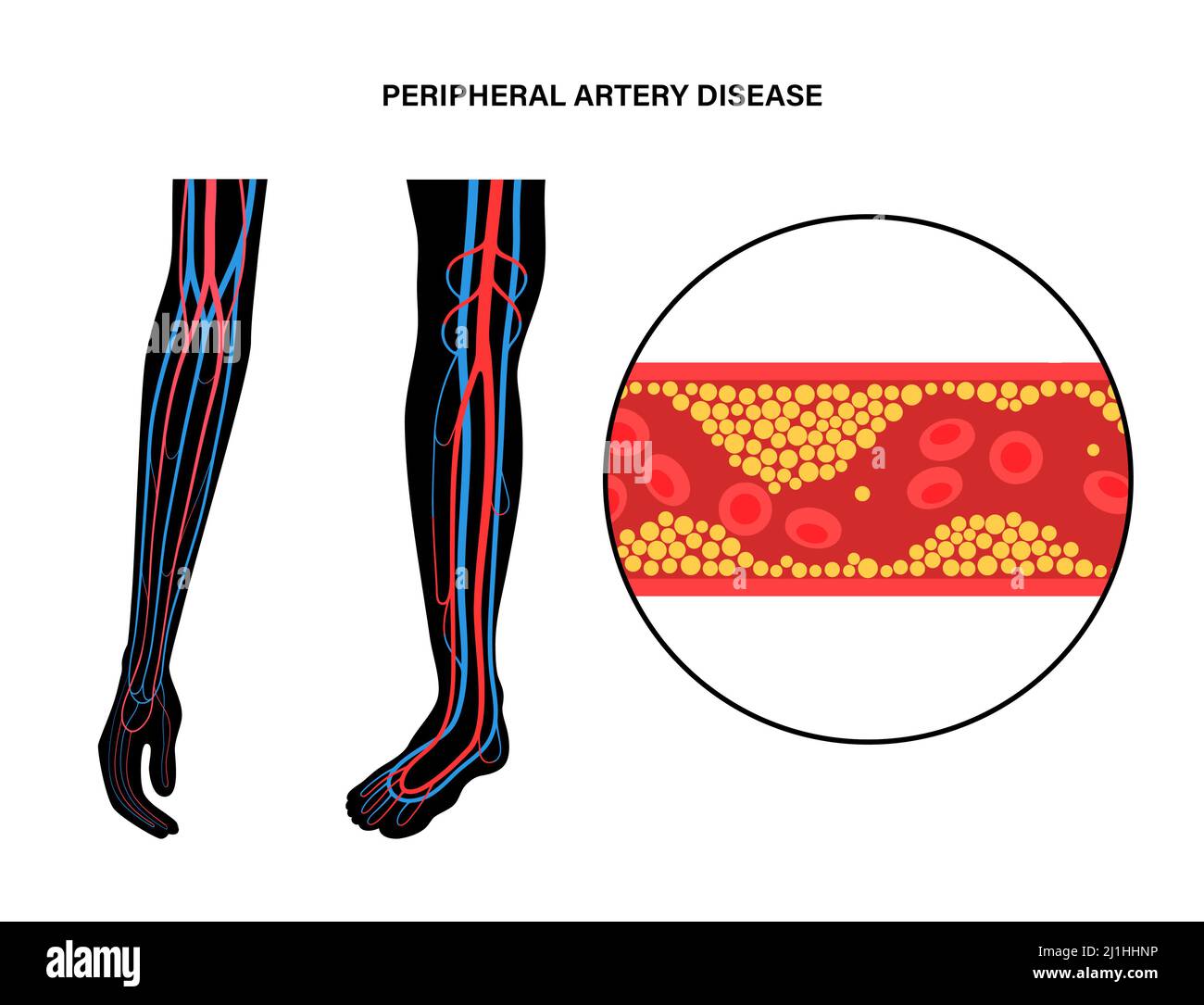 Peripheral artery disease, illustration Stock Photo - Alamy