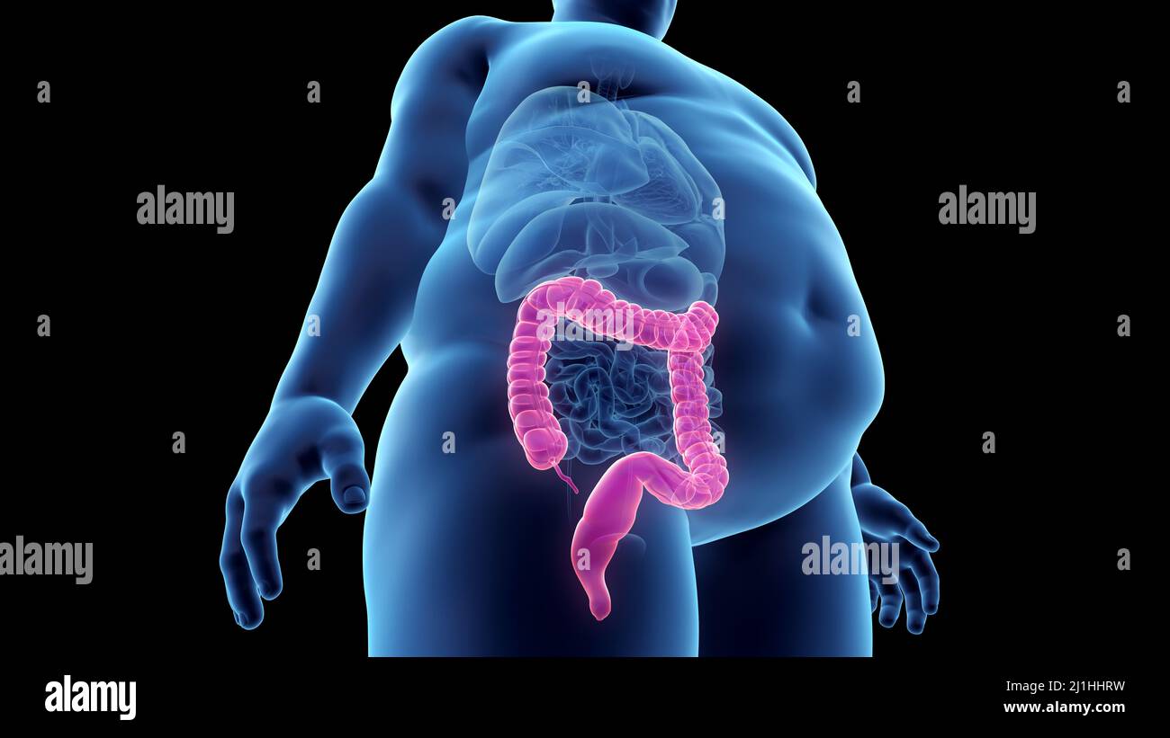 Obese man's colon, illustration Stock Photo - Alamy