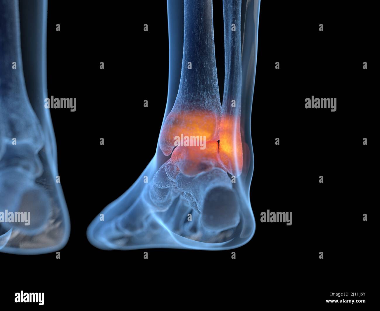 Inflamed ankle, illustration Stock Photo - Alamy