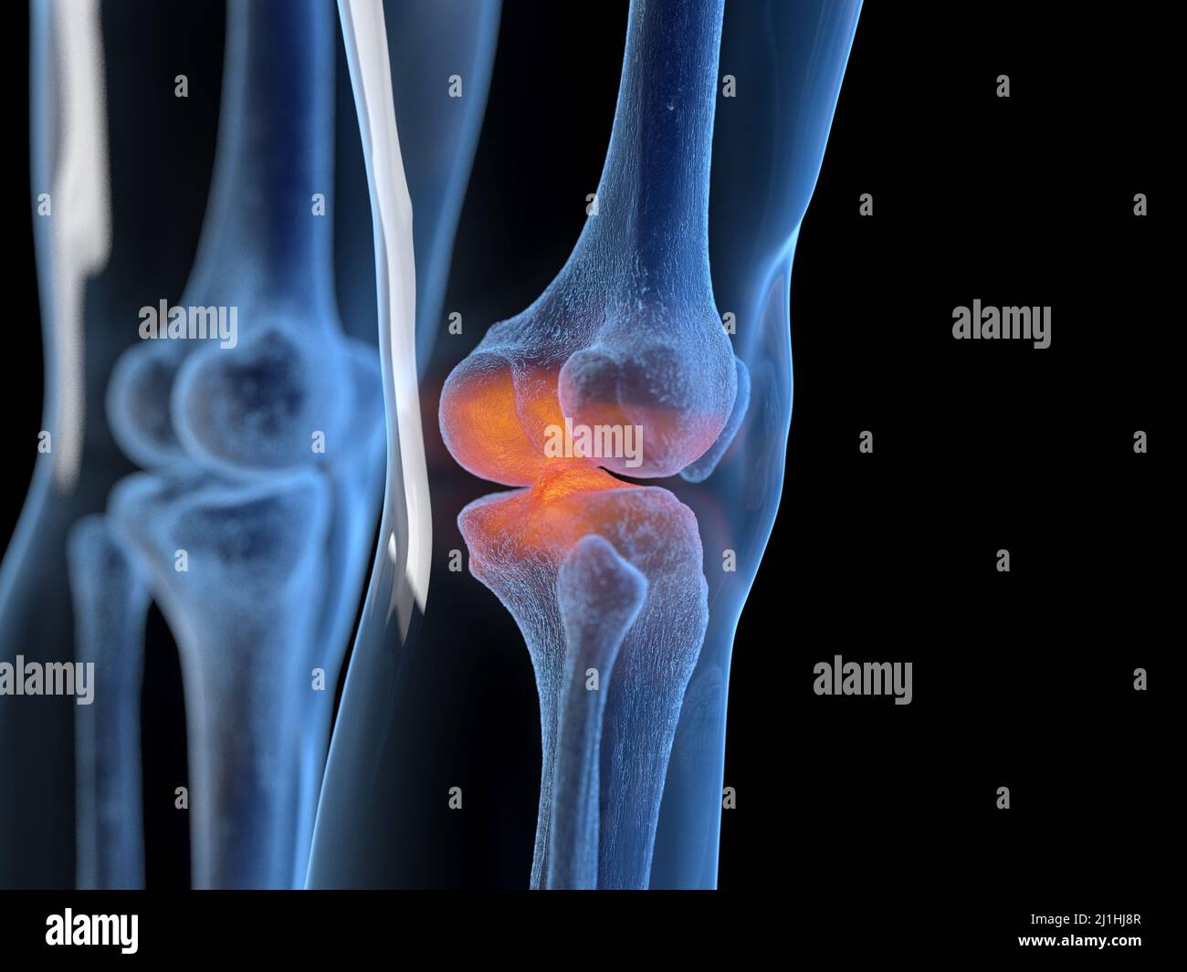 Inflamed knee joint, illustration Stock Photo - Alamy