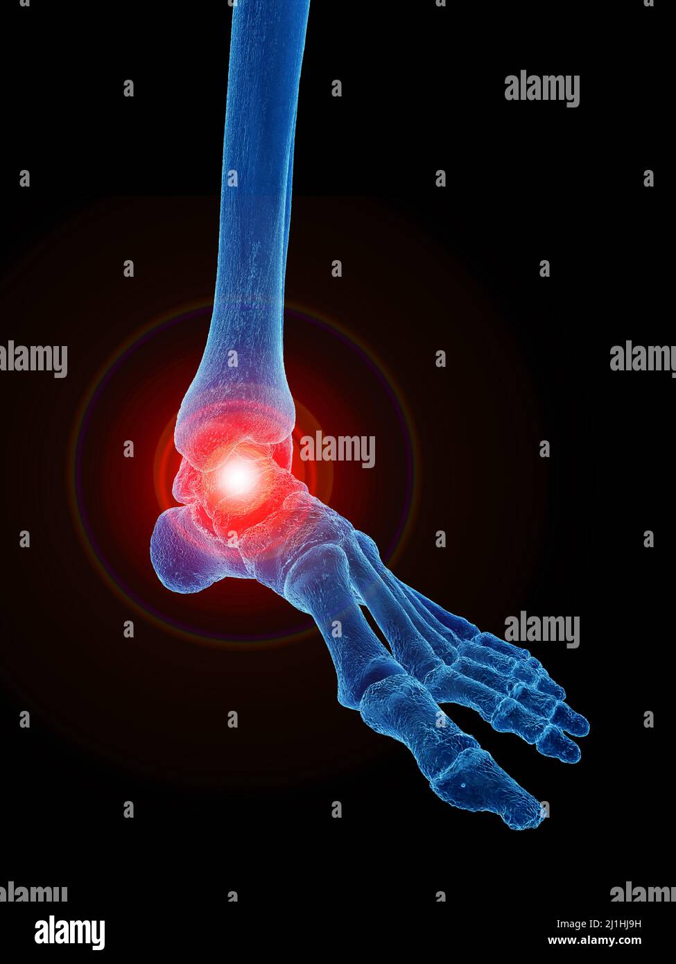 Painful ankle, illustration Stock Photo - Alamy