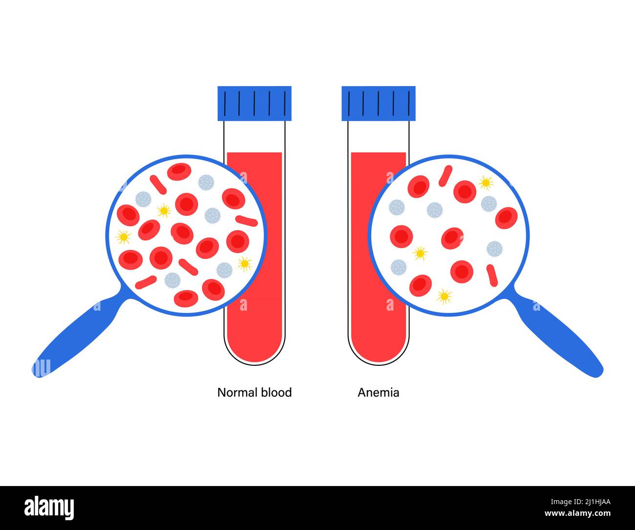 Normal blood and anaemic blood, illustration Stock Photo - Alamy