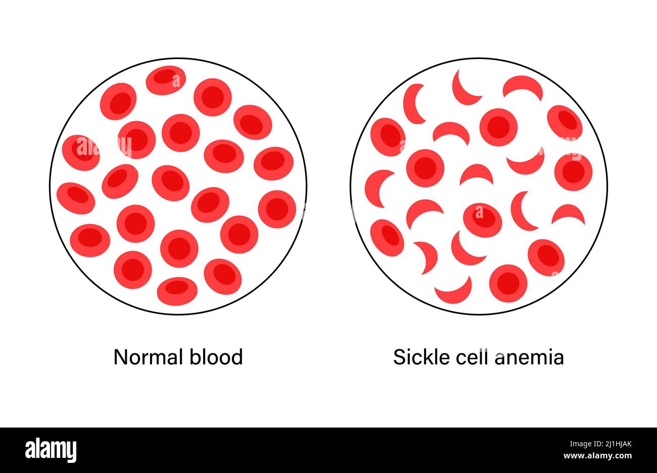 Normal blood and sickle cell blood, illustration Stock Photo - Alamy