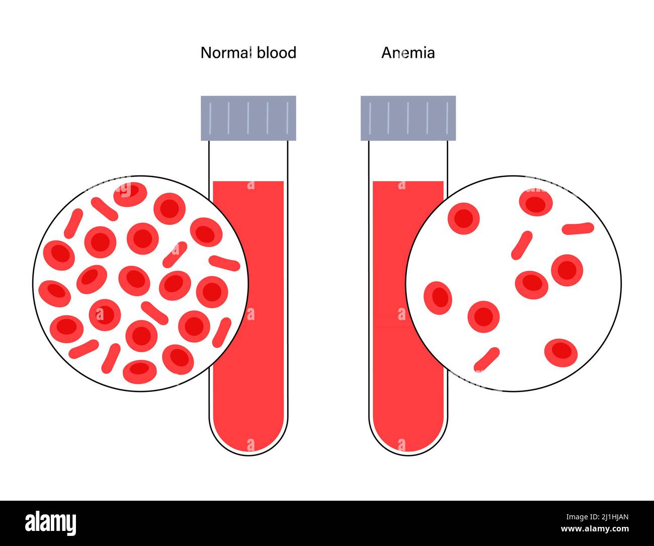 Normal blood and anaemic blood, illustration Stock Photo - Alamy