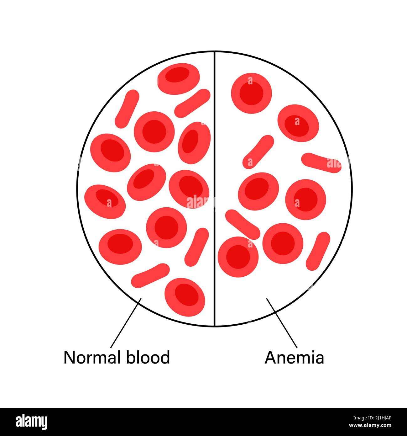 Normal blood and anaemic blood, illustration Stock Photo - Alamy