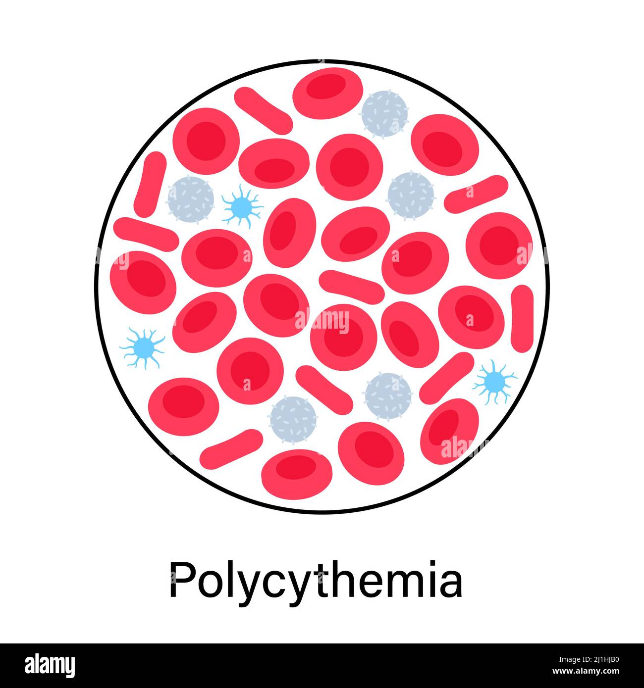 Polycythaemia hi-res stock photography and images - Alamy