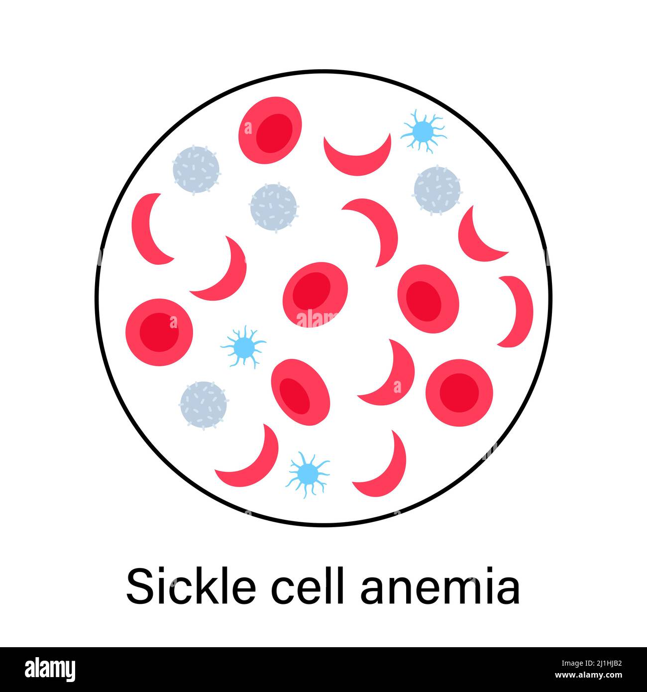 Sickle cell anaemia, illustration Stock Photo - Alamy