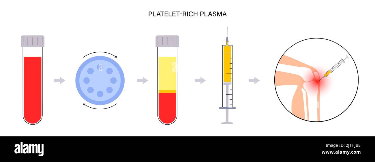 Platelet rich plasma therapy, illustration Stock Photo - Alamy