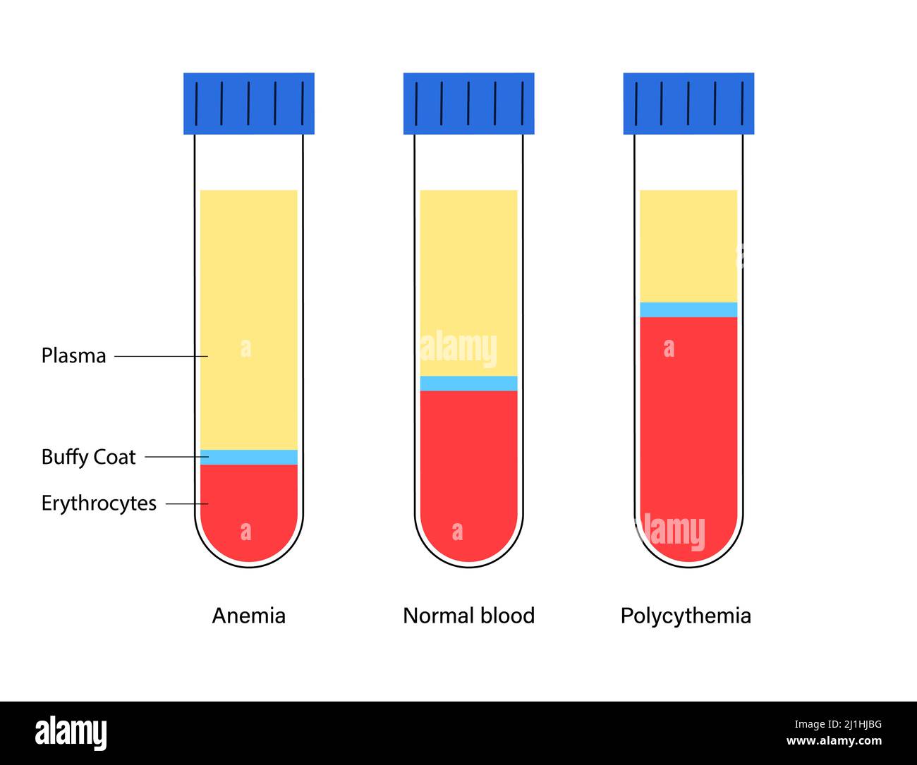 Normal and diseased blood composition, illustration Stock Photo - Alamy