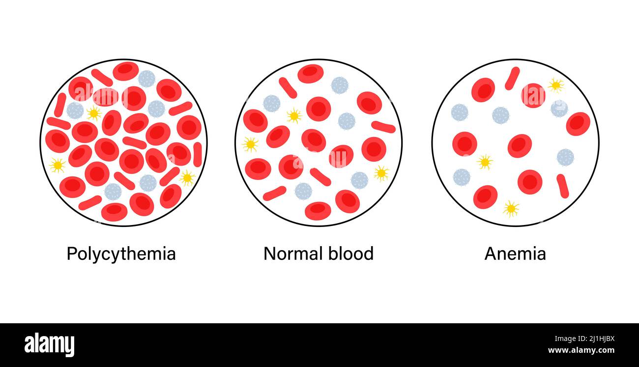 Normal and diseased blood composition, illustration Stock Photo - Alamy