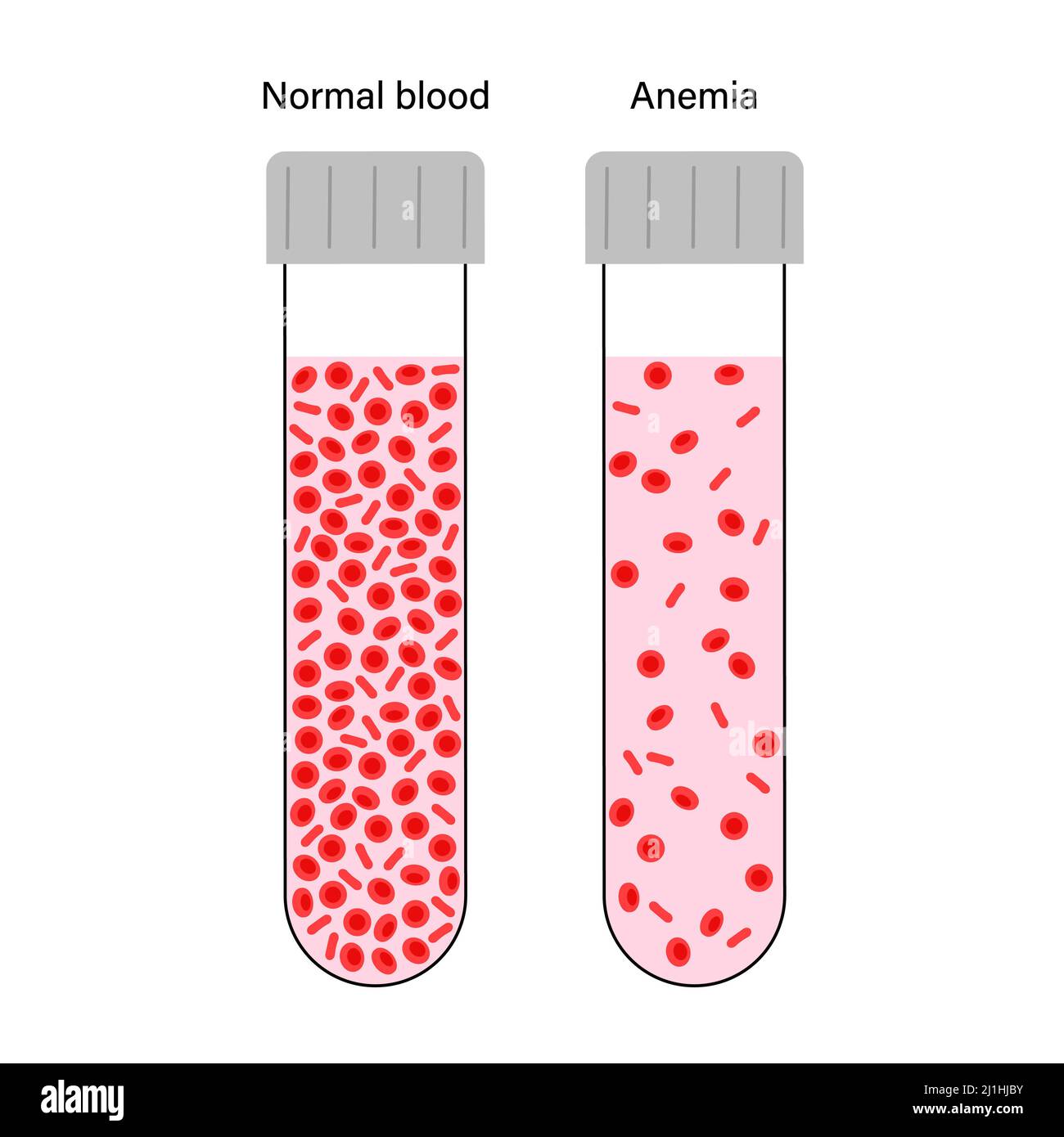 Normal blood and anaemic blood, illustration Stock Photo - Alamy