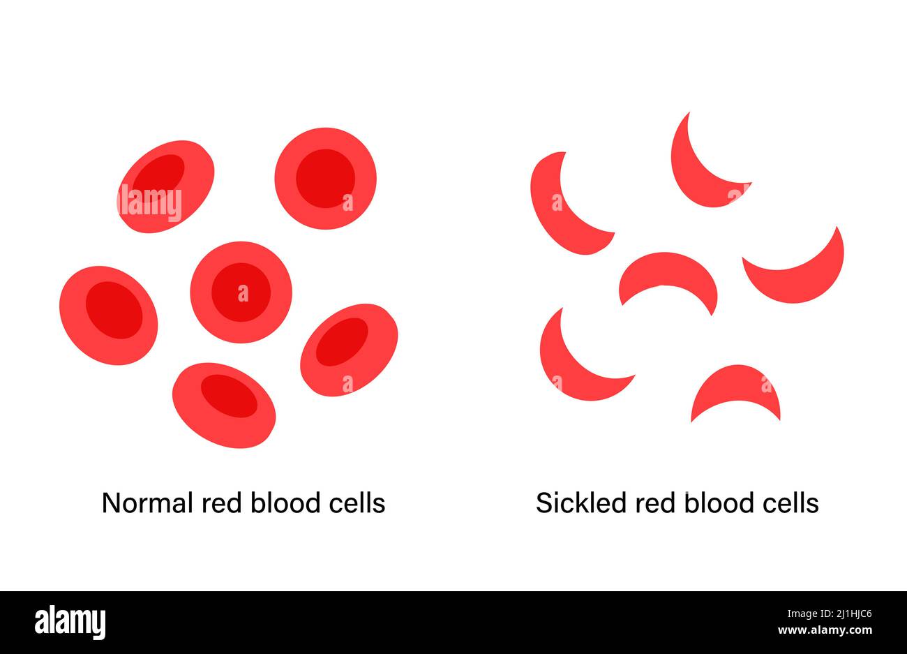 Normal blood and sickle cell blood, illustration Stock Photo - Alamy