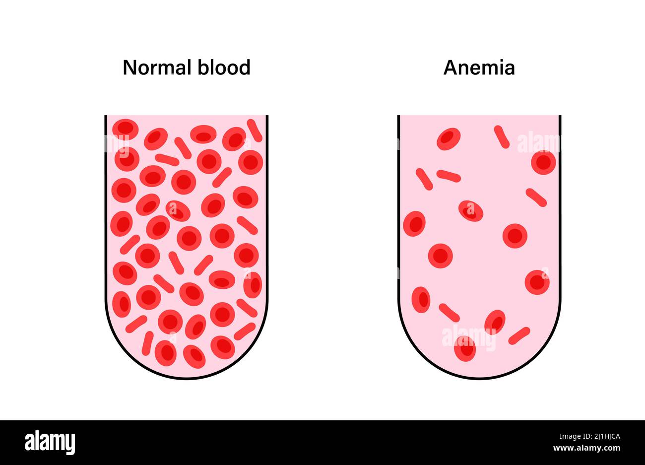 Normal blood and anaemic blood, illustration Stock Photo - Alamy