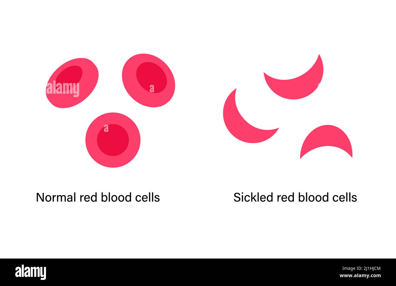 Sickle Cell Vs Normal Cell