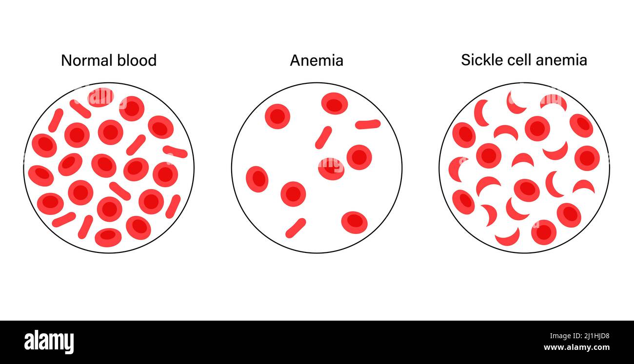 Normal and diseased blood composition, illustration Stock Photo - Alamy
