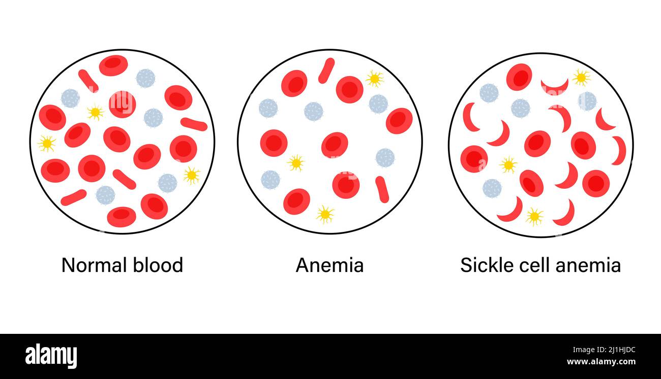 Normal and diseased blood composition, illustration Stock Photo - Alamy