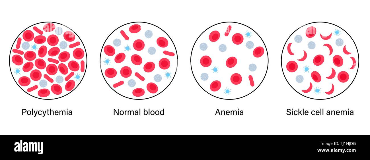 Normal and diseased blood composition, illustration Stock Photo - Alamy