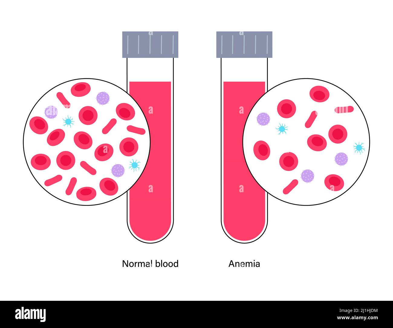 Normal blood and anaemic blood, illustration Stock Photo - Alamy